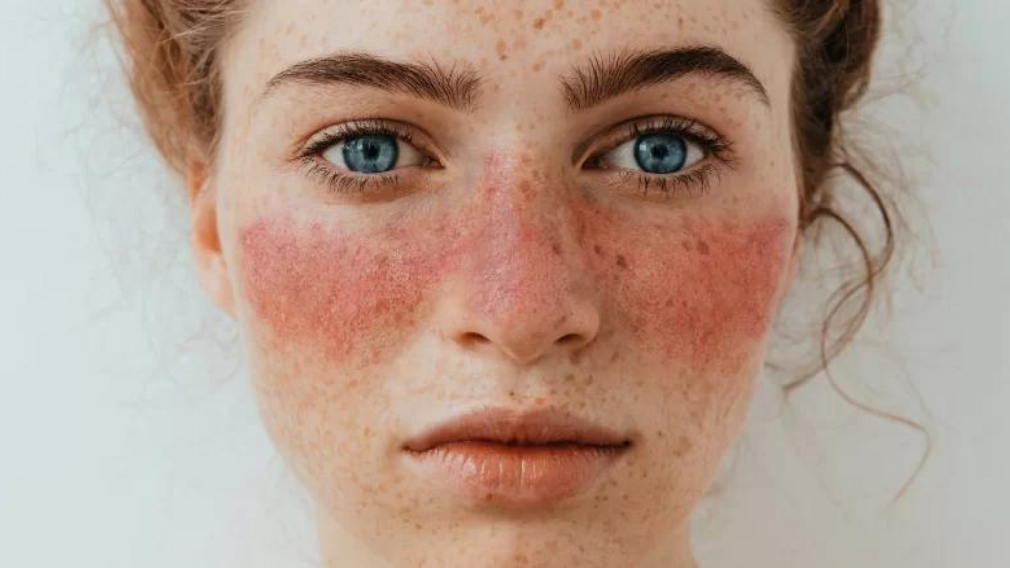 What is Lupus? | Skin Health Blog | Solbari – Solbari Australia